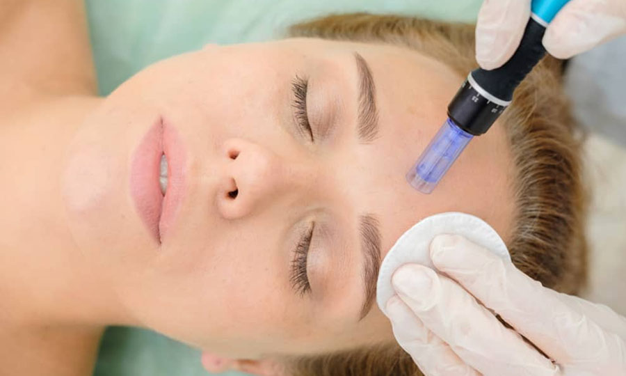 De meest gemaakte microneedling fouten - Happy Head